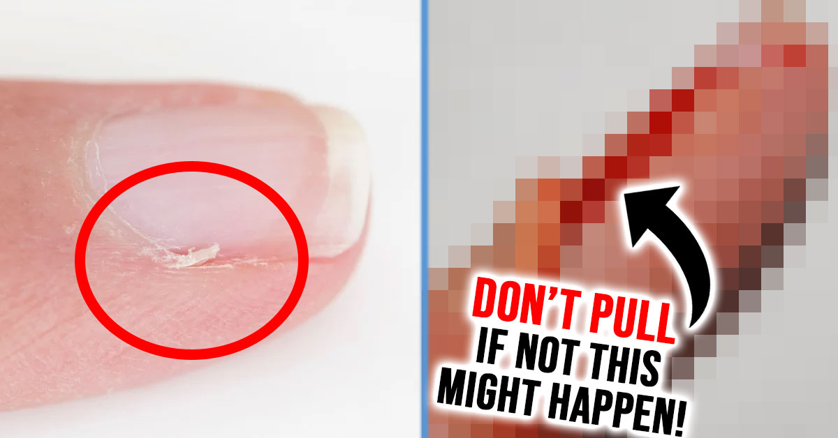 8 Facts About Hangnails, The Annoying Thing That Comes Whenever It ...