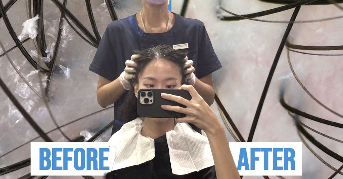 I Used to Panic When Seeing Hair on My Pillow—Until This Scalp ...