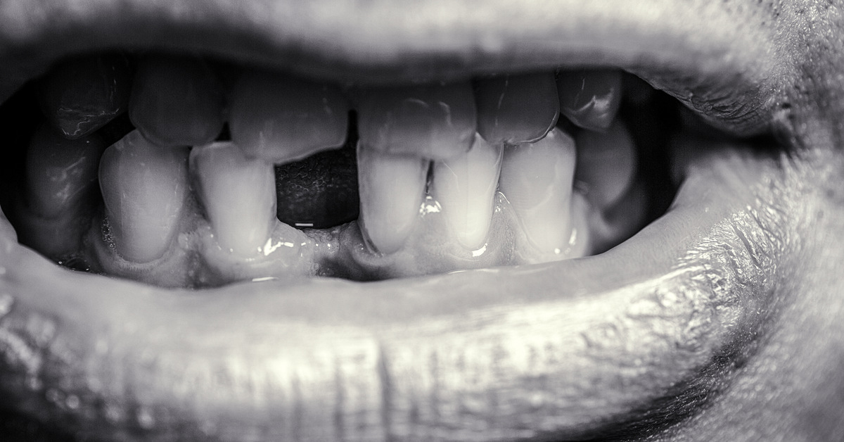Some Recovered COVID-19 Patients Allegedly Losing Their Teeth Without ...