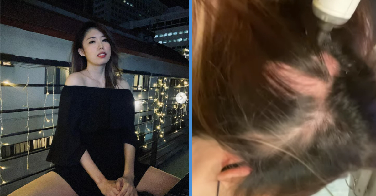 Ex-NOC Talent Nina Tan Revealed She Has Alopecia & is Losing Her Hair - Goody Feed
