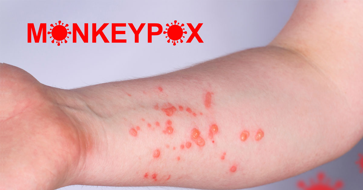 S’pore Confirms 1st Case of Imported Monkeypox Case Who Had Gone to 3 ...