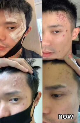 TikTok Sensation Simonboy Had Removed Tattoos on His Face to “Restart ...
